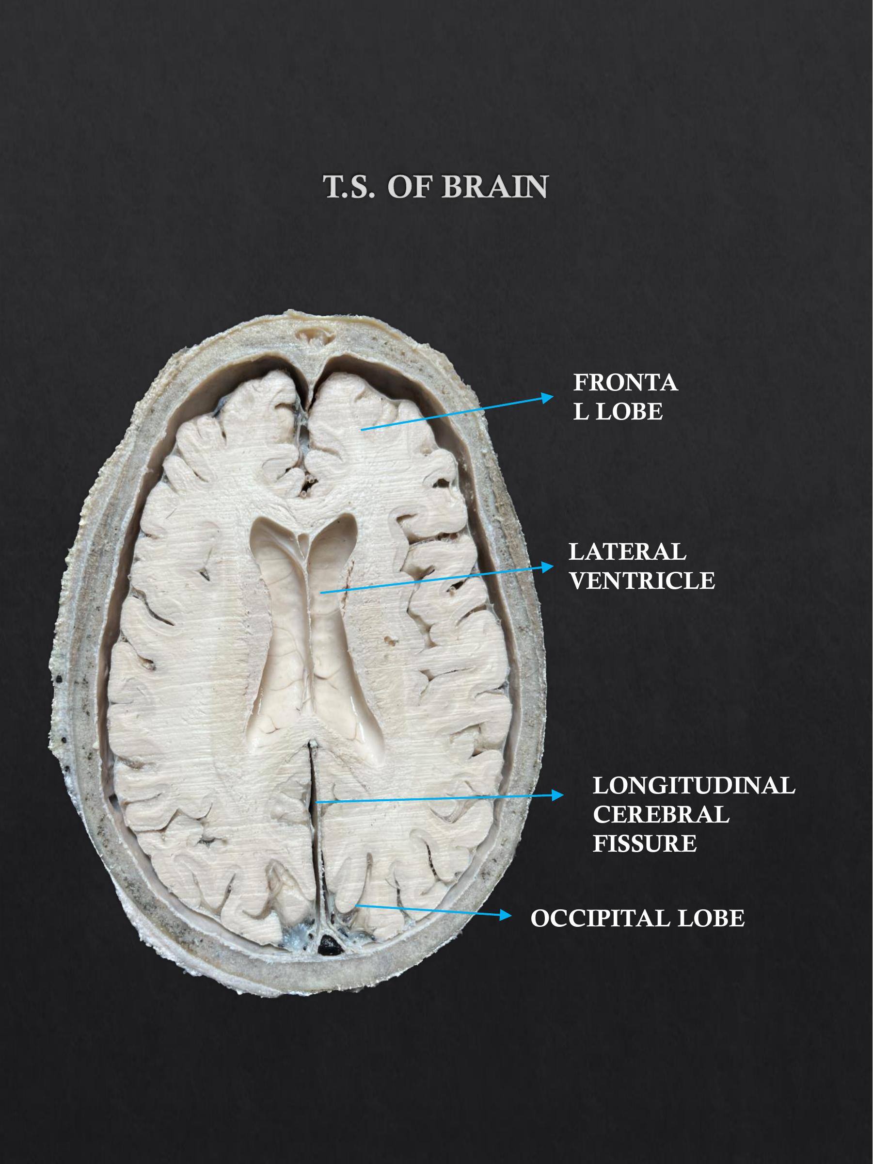 1. Transverse Section( TS) of Brain | NAMO Medical Education & Research ...