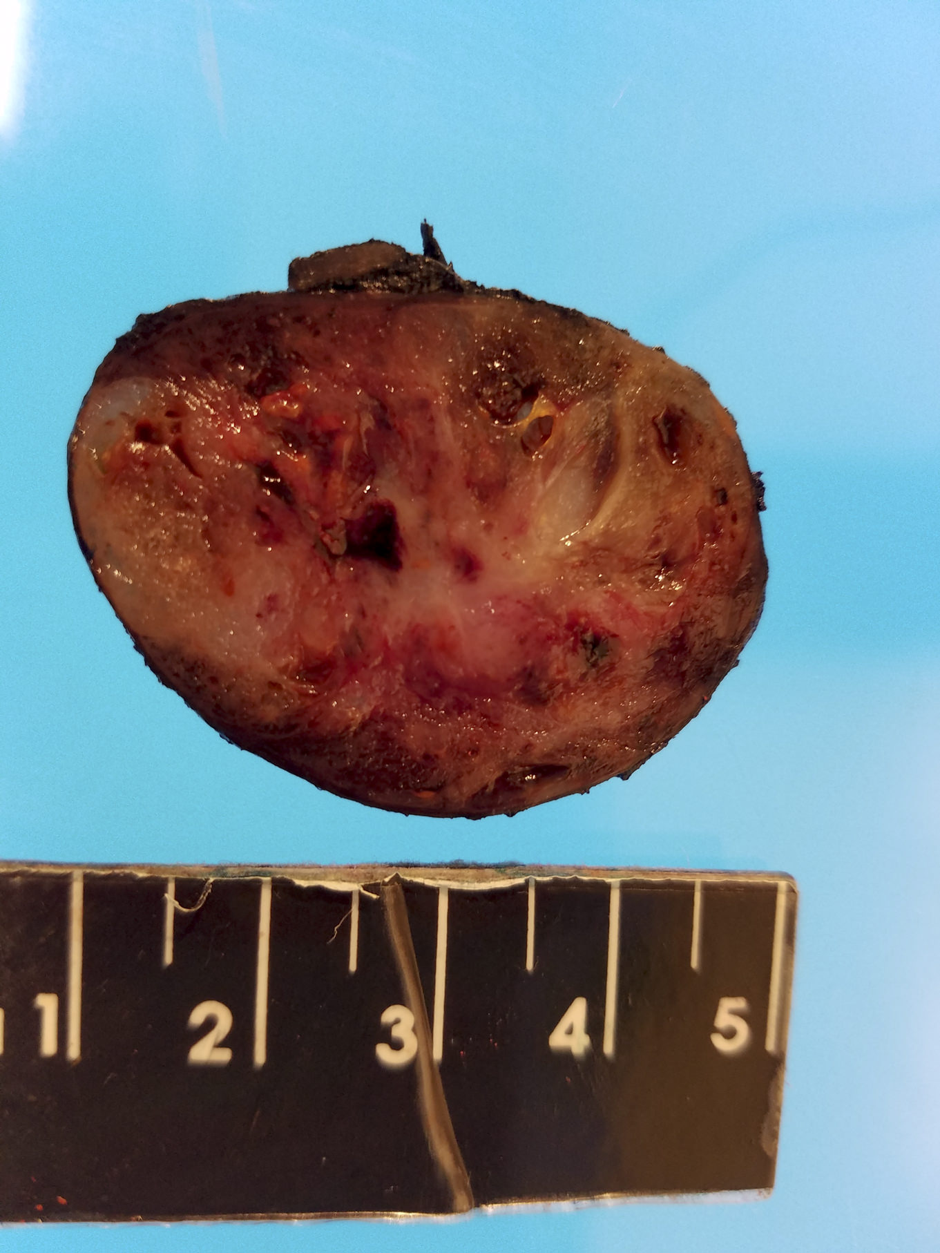 Colloid goiter | NAMO Medical Education & Research Institute